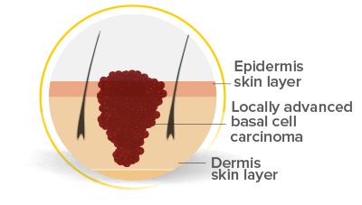 ODOMZO® (sonidegib) | Basal Cell Carcinoma